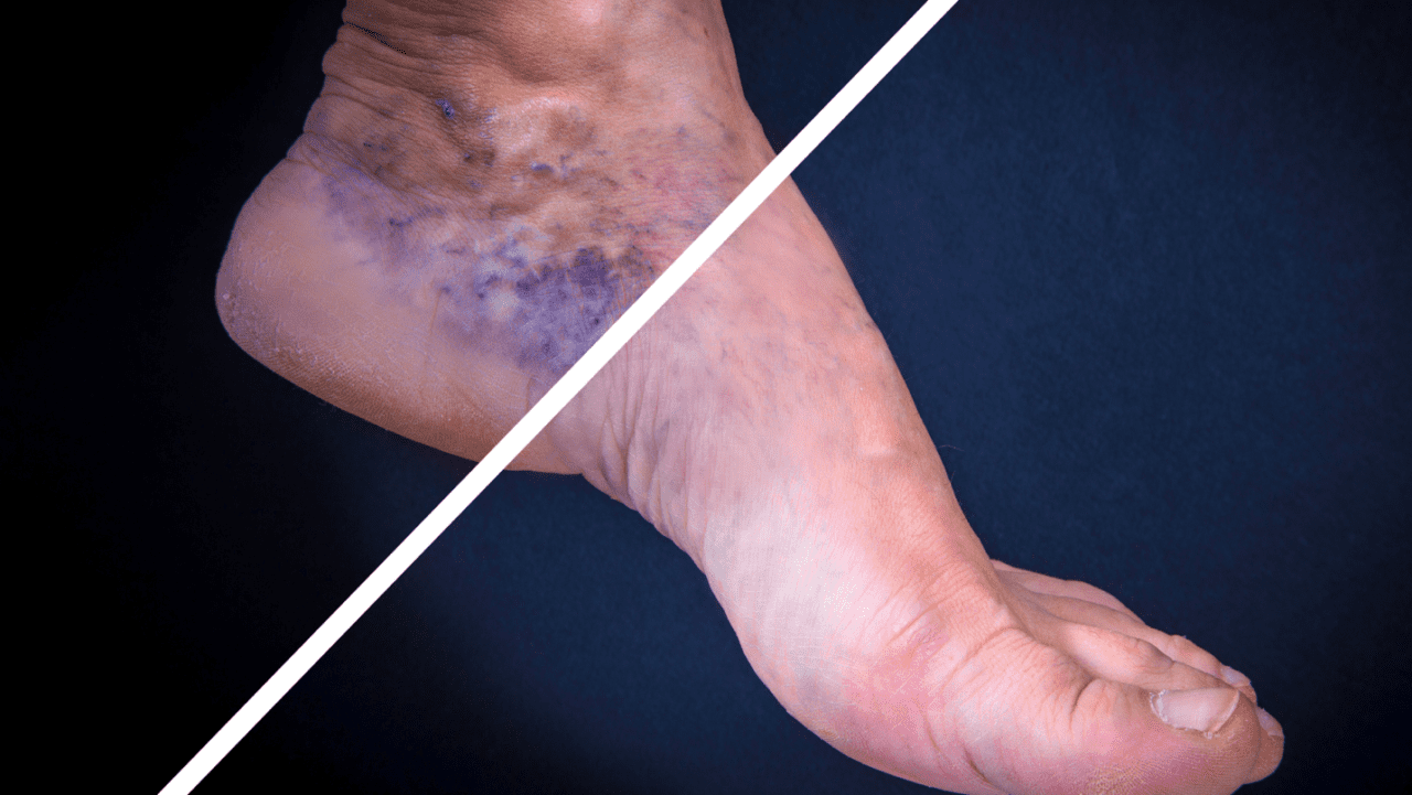 Understanding Venous Insufficiency and Varicose Veins | New York ...